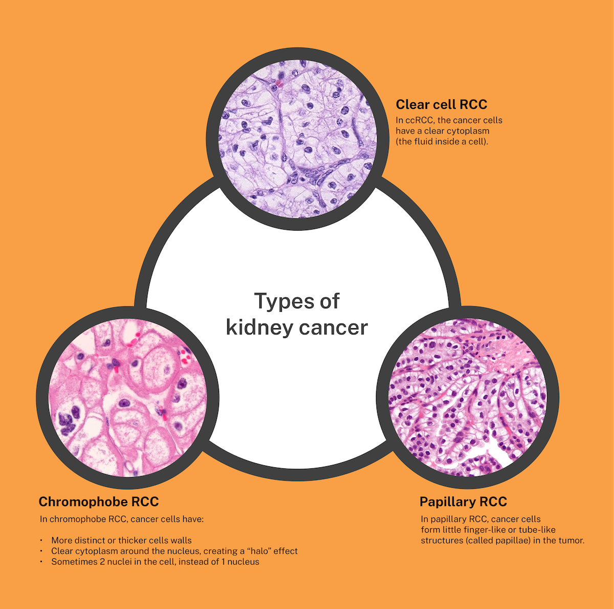 Diagnosis and Staging - Kidney Cancer Association
